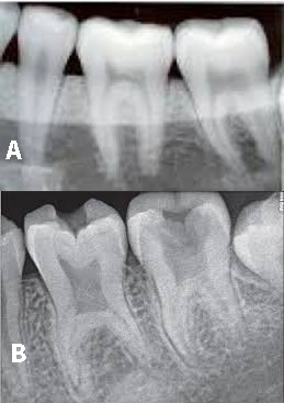 False claims of taurodont teeth in Homo floresiensis